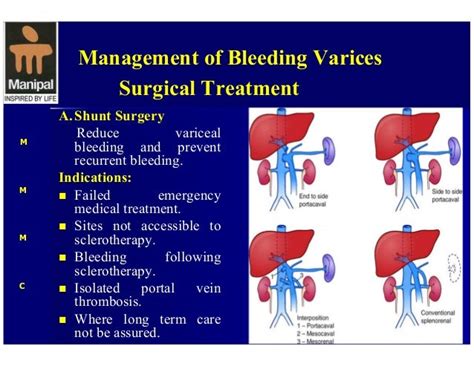 Upper Gi Hemorrhage Surgical Perspective