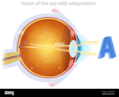 This Is An Illustration Of The Vision Of The Eye With Astigmatism