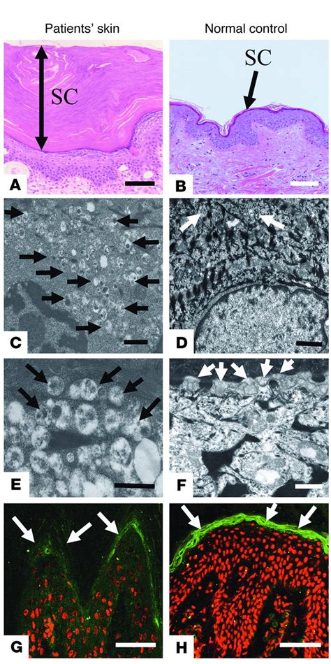 Jci Mutations In Lipid Transporter Abca12 In Harlequin Ichthyosis And