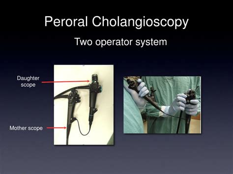 Ppt Cholangioscopy Powerpoint Presentation Free Download Id3430087