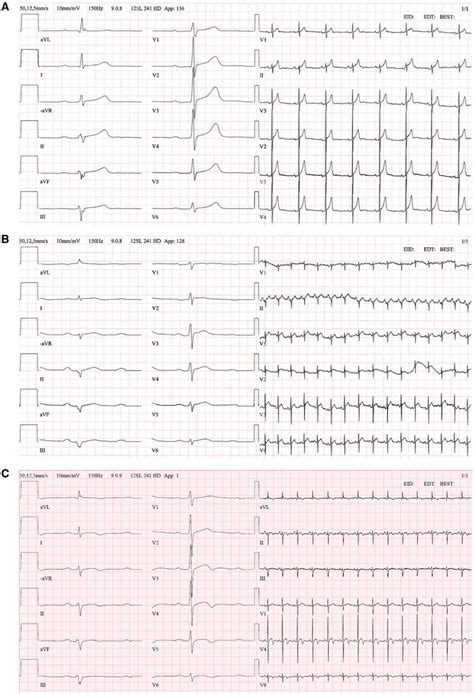 A Electrocardiogram 2019 Normal Sinus Rhythm Left Axis Deviation