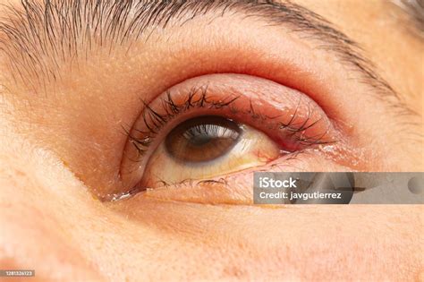 Ojo Inflamado Con Stye Infectado Párpado Superior Medicina Oftálmica