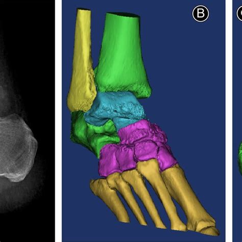 The International Cartilage Repair Society Icrs Cartilage Lesion
