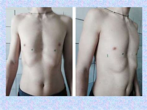 Вроджені вади грудної клітки презентация онлайн