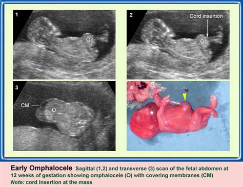 Omphalocele Department Of Obstetrics And Gynecology Faculty Of