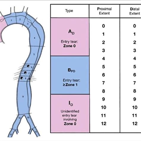 A Types Of Aortic Dissection According To The Stanford Classification Download Scientific