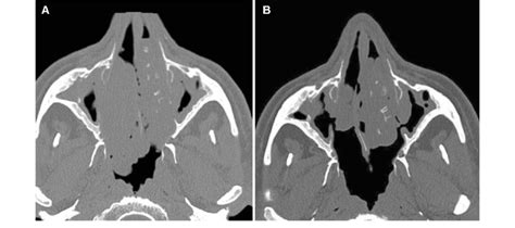 Ct Scans Of A Patient In The Nha Treatment Group With Chronic Polypoid