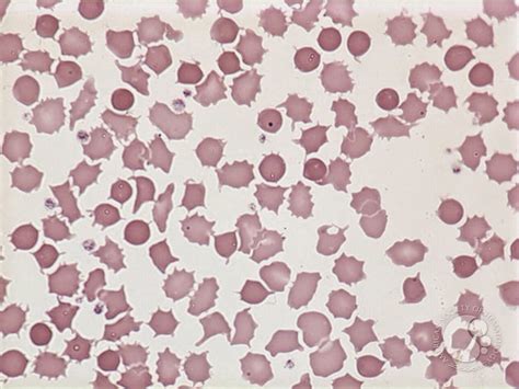 Alteración de los Eritrocitos Alteraciones de la forma