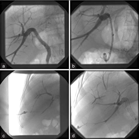 Causes And Treatment Of Bile Leaks At The Puncture Site After Percutaneous Transhepatic Biliary