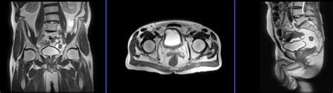 Msk Pelvis Mri Protocol And Planning Mri Musculoskeletalmsk Pelvis
