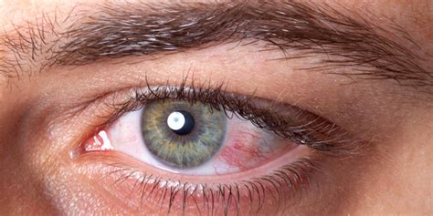 Ikervis Ciclosporin Treatment Now Pbs Listed Optometry Australia