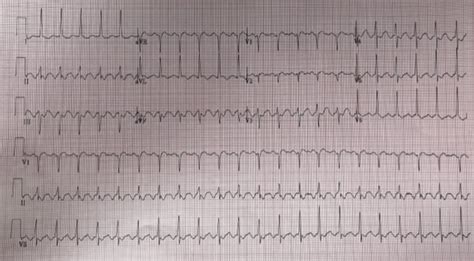 Atrial Fibrillation Vs Atrial Flutter Ecg