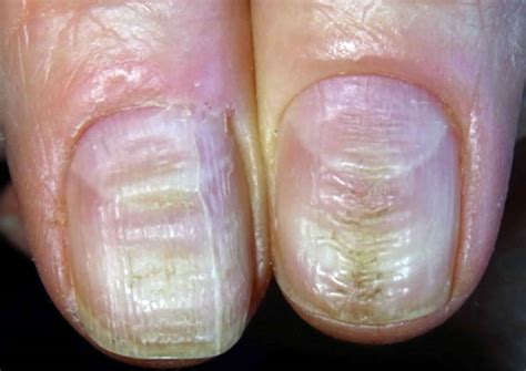 Nail Dystrophy Definition Causes And Treatment