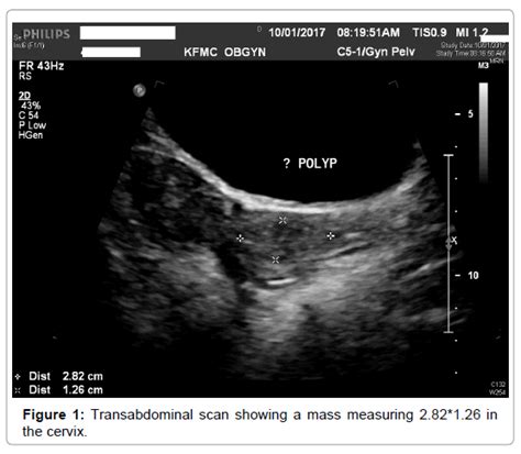 Hysteroscopic Resection Of A Giant Cervical Polyp With Preservation Of Hymen Scitechnol