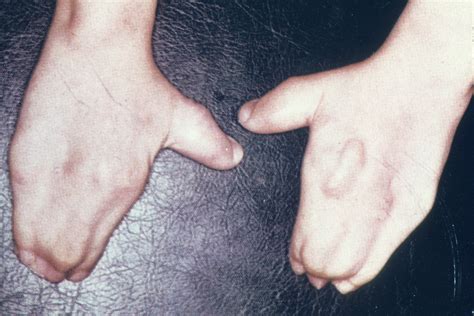 Apert Syndrome Hereditary Ocular Diseases