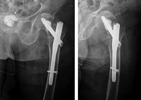 Tfn Advanced Proximal Femoral Nailing System Tfna