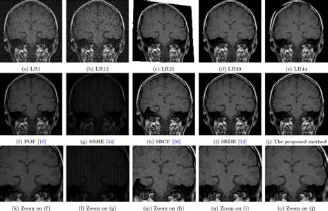 Comparisons Of Reconstructing Mri Brain 2 Image With Different Sr