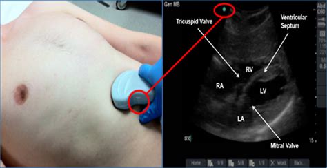 Subxiphoid Pericardial Window