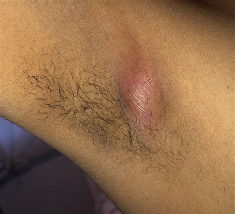 Armpit Rash Itchy Candida Causes And Treatment Face Surgery