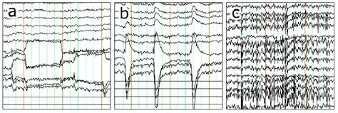 A Convolutional Neural Network For The Removal Of Simultaneous Ocular And Myogenic Artifacts