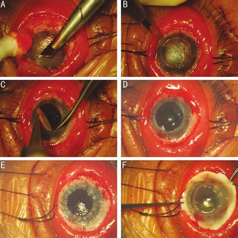 The Process Of Transplantation A The Corneal Tissue Lesion Of Pseudo