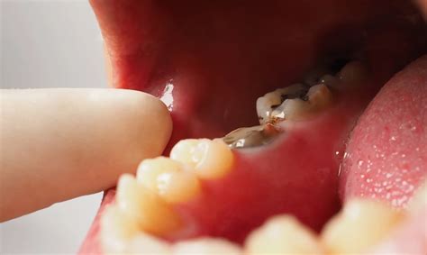 اسباب تسوس أسنان الأطفال الصغار وطرق علاجها من Midic Arab Midic Arab