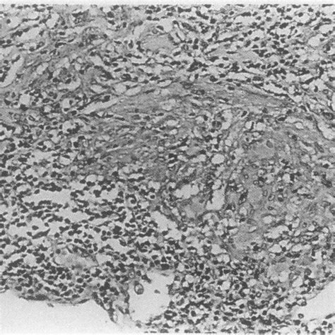 Sarcoid Lymph Node Stained With L26 Anticd20 B Lymphocyte Specific Download Scientific Diagram