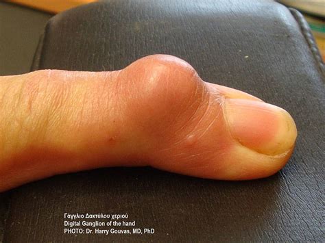 Dont Bash The Bible Bump Aka The Ganglion Cyst