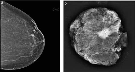 Figure 1 From Efficacy Of Localization Of Non Palpable Invasive Breast Cancer Wire