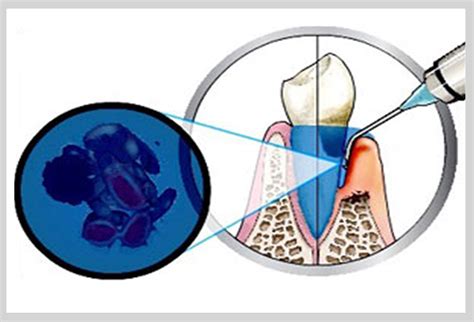 Photodynamic Therapy Moses