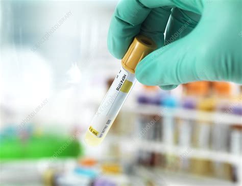 Hepatitis Test Stock Image F0243821 Science Photo Library