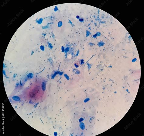 Smear Of Acid Fast Bacilli Afb Stained From Sputum Specimen With