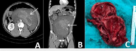 Hematoma Abdominal Infectado Rupture Of A Huge Infectious Abdominal