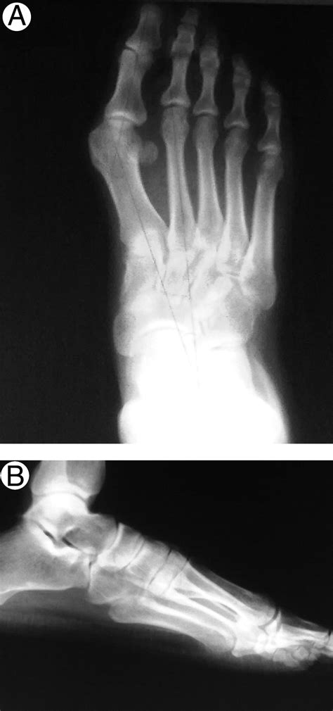 Distal First Metatarsal Dome Crescentic Osteotomy For Repair Of Mild