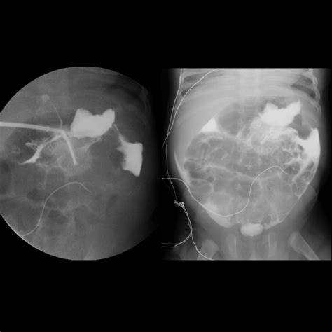 Pediatric Gastrostomy Tube Malfunction Malposition Misposition