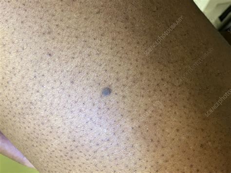 Dermatofibroma Stock Image C0571913 Science Photo Library