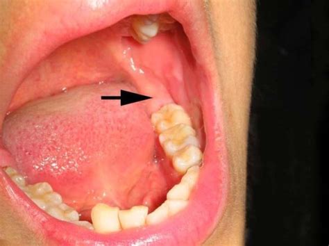 Swollen Gums In Back Of Mouth Causes Symptoms And Effective Remedies