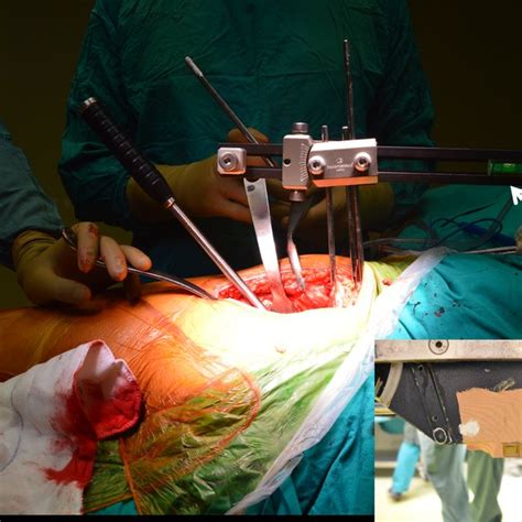 A Apparatus Used To Determine The Inclination Angle Of The Acetabular