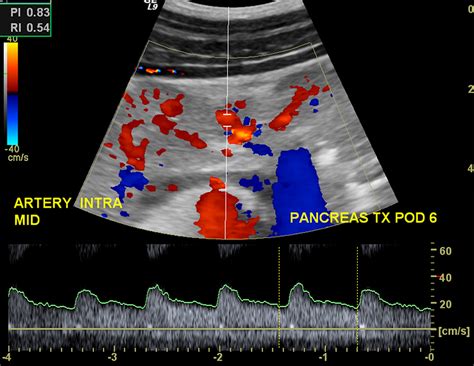 Pancreas Transplant Imaging How I Do It Radiology