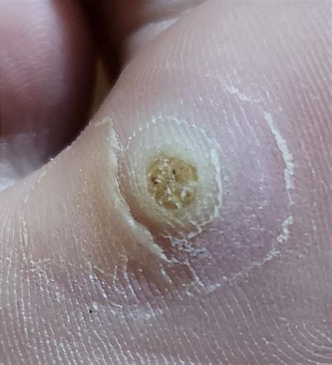 Plantar Wart Is It Finally Gone Rwarts