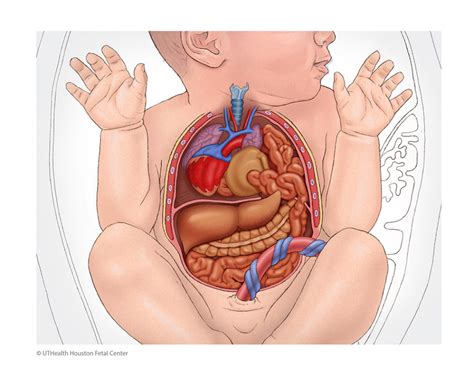Congenital Diaphragmatic Hernia Cdh Ut Physicians