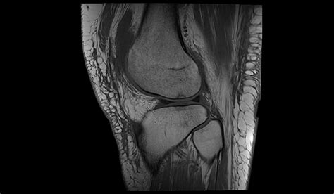 Patellar Dislocation Mri Radiology Article On Patella Dislocation