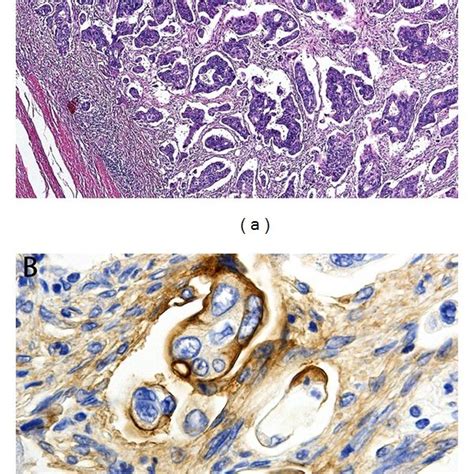 Pdf Micropapillary Pattern At The Invasive Front And Its Association