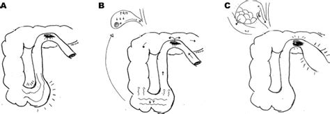 A Pictorial Sketch Of The Suggested Pathogenesis Of Gallstone Ileus In