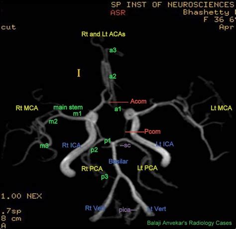 Neuroradiology Cases Circle Of Willis Anatomy Interventional Radiology Radiology Circle Of