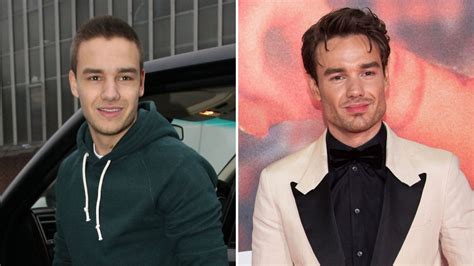 Did Liam Payne Get Plastic Surgery Jaw Face Photos Life And Style