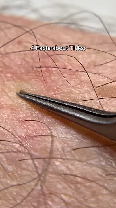 [video] Bug Bite Thing On Linkedin Bugbitething Bugbitethingtickremover Tickremover