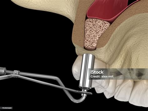 부 비 동 리프트 수술새로운 뼈를 추가 합니다 3d 일러스트레이션 집어들기에 대한 스톡 사진 및 기타 이미지 집어들기 코곁굴 0명 Istock