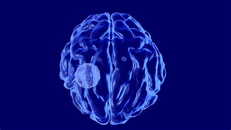 Brain Abscesses Symptoms Causes And Treatment Mdmedicine