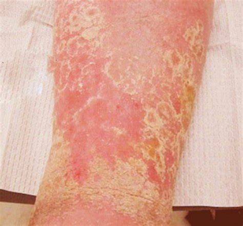 Stasis Dermatitis Pictures Symptoms Causes Treatment Diagnosis